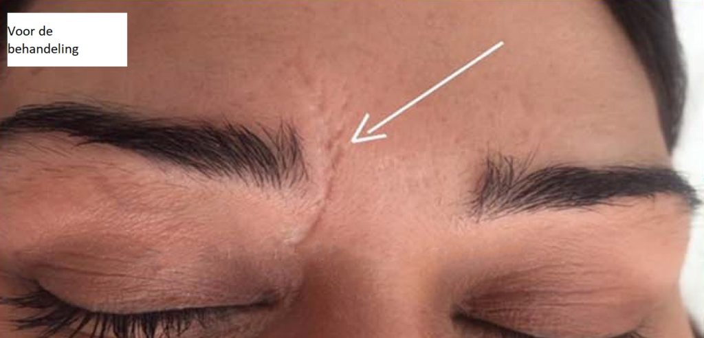 Wat te doen bij lelijke littekens?Irma Hulscher - Permanente Make up